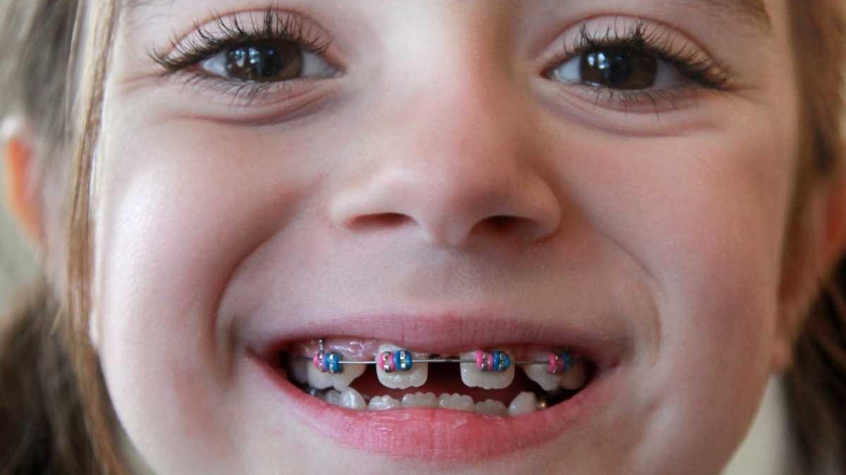 Parental guidance: Encouraging kids to wear retainers - Newsday