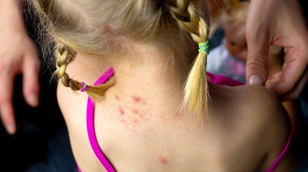 Molluscum contagiosum is a stubborn rash - Newsday