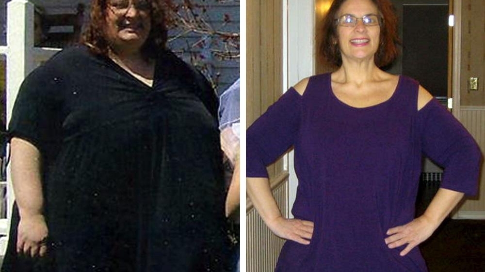 Theresa Devlin: Surgery 'the start of a lifestyle change' - Newsday