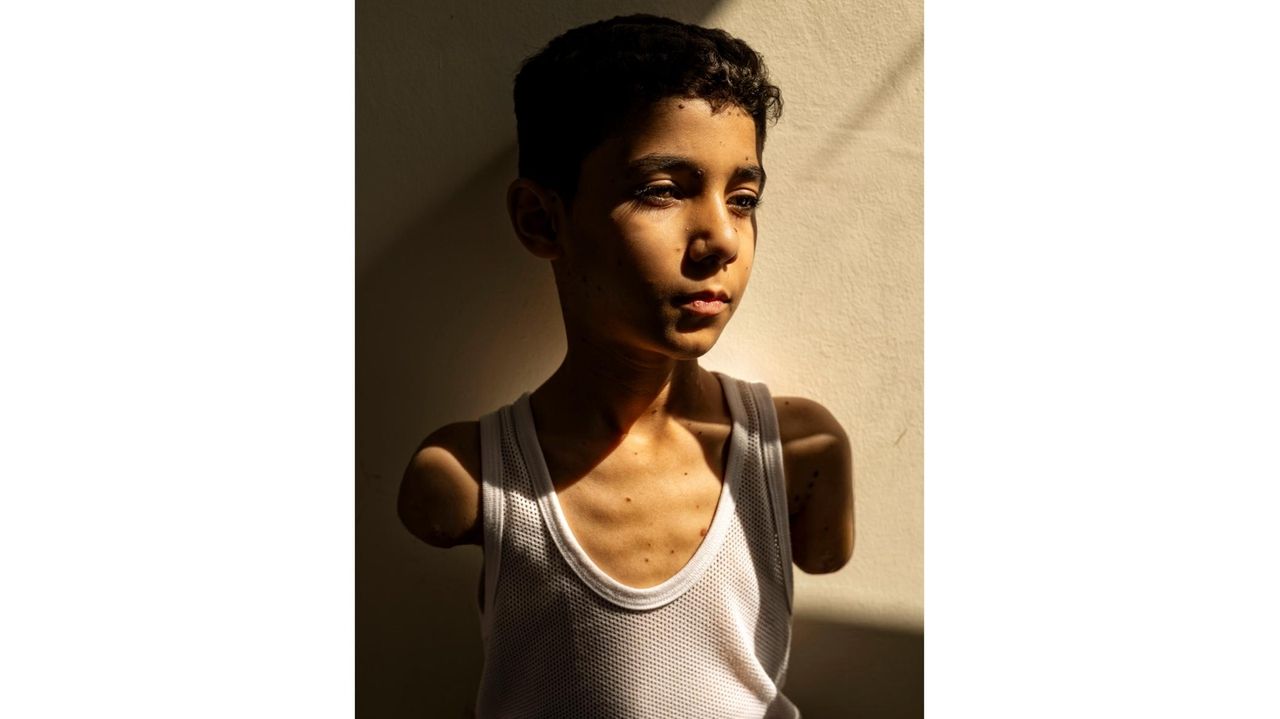 Portrait of Palestinian boy who lost both arms is World Press Photo of ...