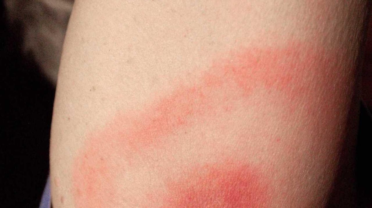 Lyme disease & bartonella mimic many diseases - Newsday